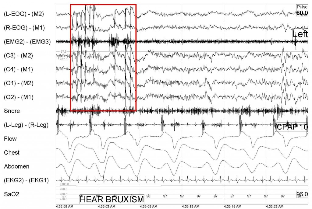 Parasomnias - AXG Sleep Diagnostics